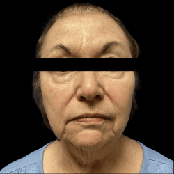 Before and After Photos Kansas City, MO - Plastic Surgery Gallery ...