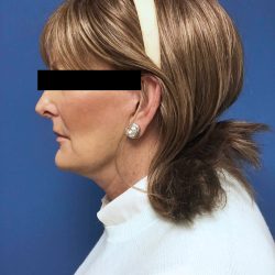 Before and After Photos Kansas City, MO - Plastic Surgery Gallery ...