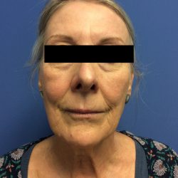 Before and After Photos Kansas City, MO - Plastic Surgery Gallery ...