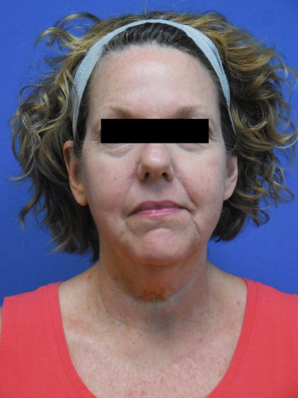 Best Facelift Kansas City, Leawood | Monarch Plastic Surgery