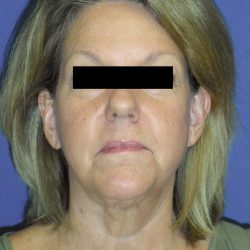 Before and After Photos Kansas City, MO - Plastic Surgery Gallery ...