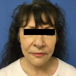 Before and After Photos Kansas City, MO - Plastic Surgery Gallery ...