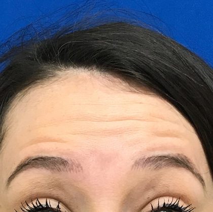 Patient #1061 Injection Before and After Photos Kansas City - Plastic ...