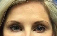 Patient #1111 Injection Before and After Photos Kansas City - Plastic ...