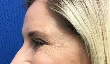 Patient #1116 Injection Before and After Photos Kansas City - Plastic ...