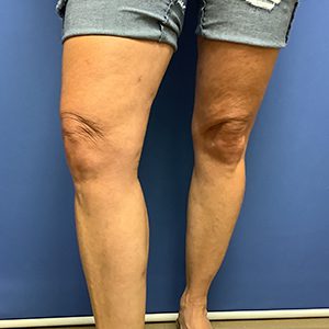 Patient #2221 Liposuction Before and After Photos Kansas City, MO ...