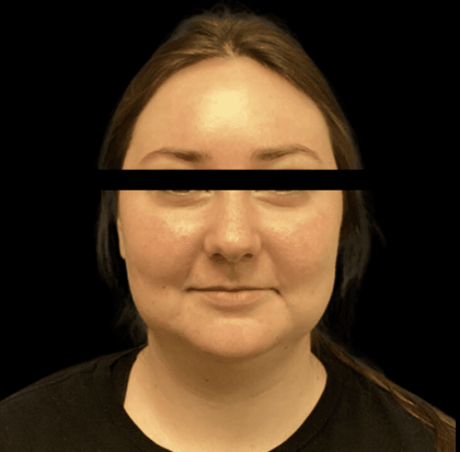 Best Liposuction Kansas City, Leawood | Monarch Plastic Surgery