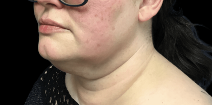 Best Liposuction Kansas City, Leawood | Monarch Plastic Surgery